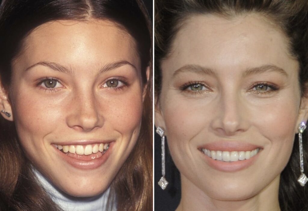 Familiar Smiles: Celebrities Who Got Their Teeth Done (July 2025 ...